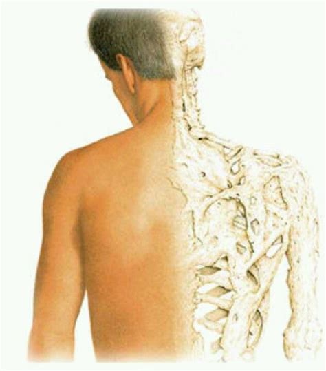 Fop Is One Of The Rarest Diseases In The World With Only 700 Confirmed