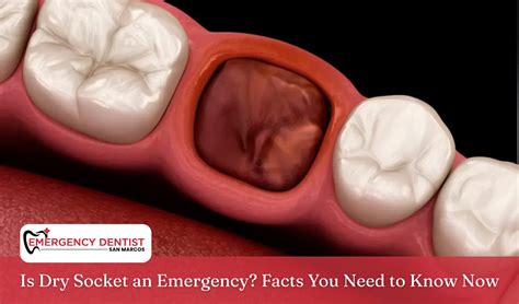 Is Dry Socket An Emergency Facts You Need To Know Now