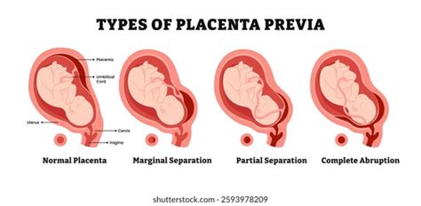 Placenta Previa Abruption Photos Images And Pictures Shutterstock
