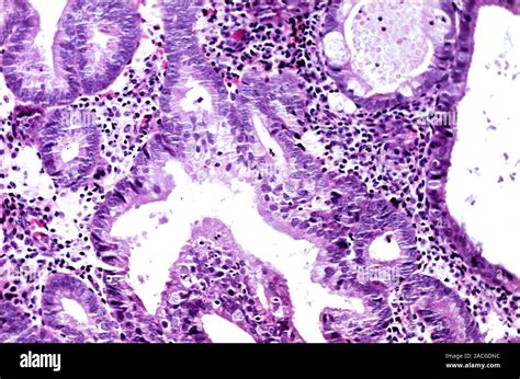 Endometrial Hyperplasia Light Micrograph Of A Section Through Tissue