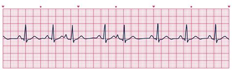 Premature Atrial Contraction Strip