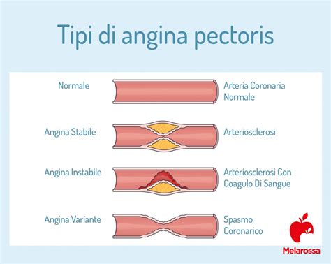 Angina Pectoris Cosè Cause Sintomi Diagnosi Cure