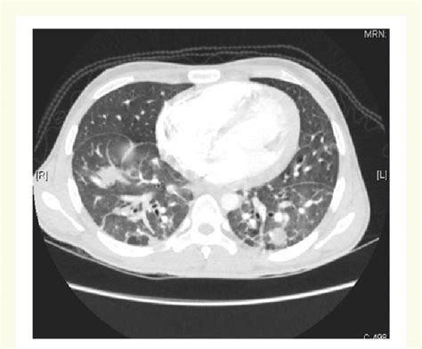 Computed Tomography Angiography Of Pulmonary Arteries Shows Complete To