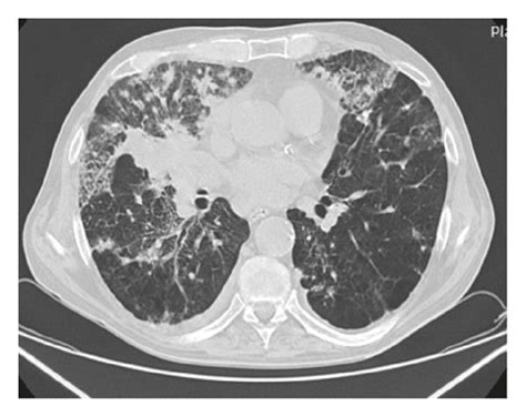Thoracic Ct At The Initial Diagnosis Without Intravenous Download