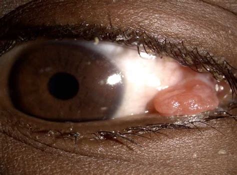 Pyogenic Granuloma Eye Symptoms