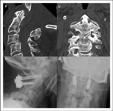 Figure 2 From Aospine—spine Trauma Classification System The Value Of