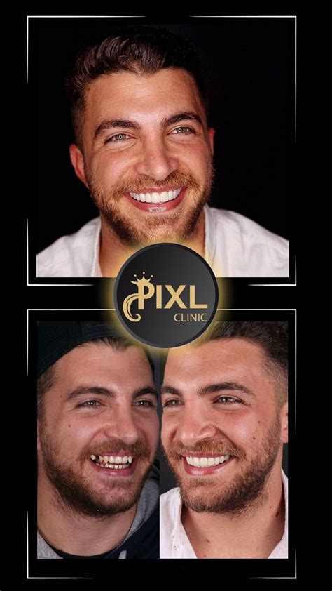 How To Fix Pacifier Teeth 2 Effective Methods That Work