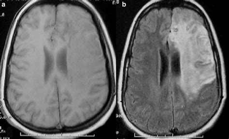 Irm Encéphalique Coupes Axiales En Séquence Pondérée T1 A Et T2 Download Scientific Diagram