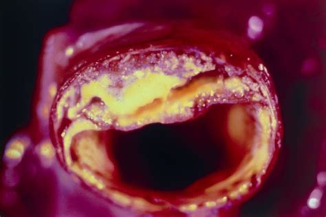 Aterosclerosis Aterosclerosis Manual Merck Versión Para Profesionales