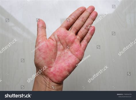 8 Hundred Eczema Dermatitis On Palm Hand Fingers Royalty Free Images