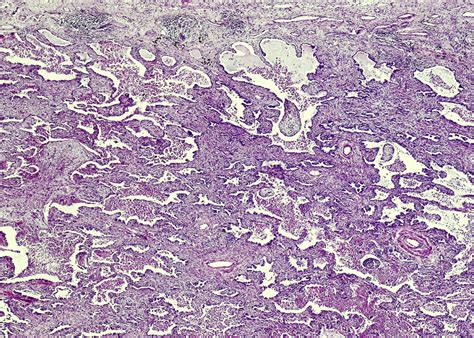 Small Cell Lung Cancer Light Micrograph Stock Image C0500333
