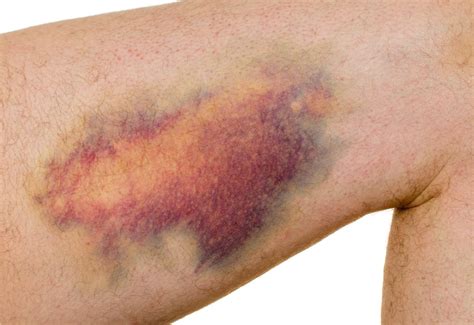 Bruises — Medical Secrets