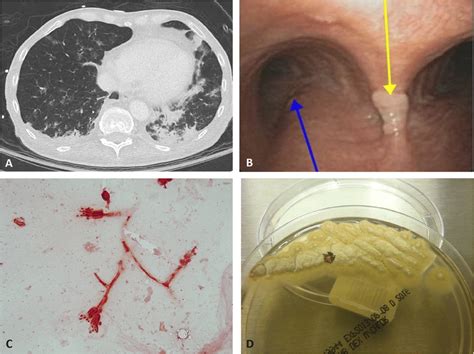 A Ct Of The Patients Chest Showing Nodular Infiltrates Highly