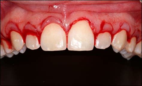 Incisão Em Bisel Interno Download Scientific Diagram