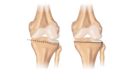 Knee Realignment Surgery Osteotomy