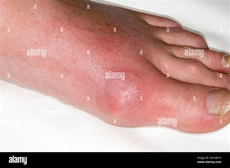 Close Up Of The Red And Inflamed Joint At The Base Of The Big Toe In A