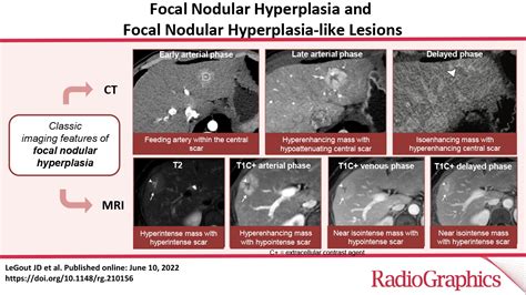 Focal Nodular Hyperplasia And Focal Nodular Hyperplasia Like Lesions