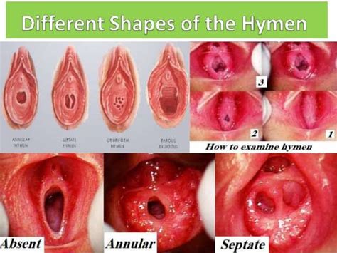 Anatomy Of Hymen Womens Health Advocate Reproductive Health