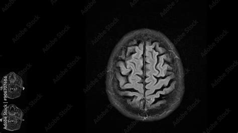 Magnetic Resonance Imaging Of The Brain Mri Of The Brain Medical