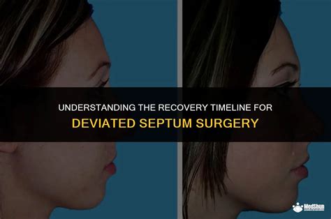 Understanding The Recovery Timeline For Deviated Septum Surgery Medshun