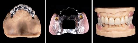 La Prothèse Composite à Lère Du Numérique Dr Billon Et Axel Guego