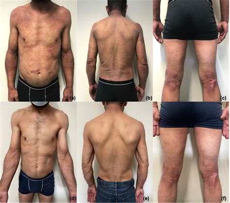 Atopic Dermatitis Patient With Hepatitis C Treated With Dupilumab—a