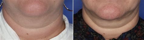 Kybella — Golden Glow Medical Spa