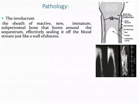 Osteomyelitis Pptx
