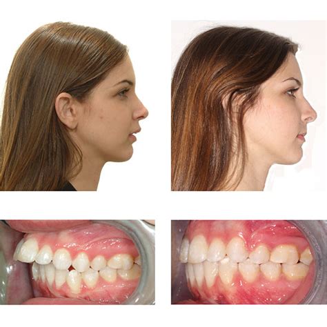 Overbite Side View Side View Of Human Jaw With Overbite Dental