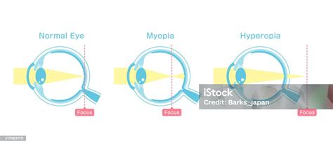 Vector Illustration Of Normal Vision And Myopia And Hyperopia Stock