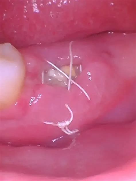 Tooth Extraction Healing In Pictures