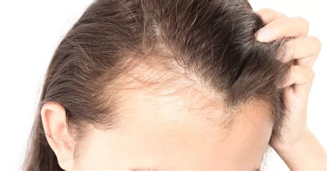 What Does A Healthy Scalp Look Like Rsvp Live