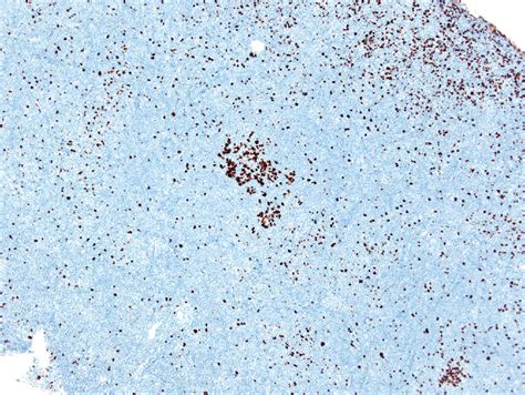 Hematolymphoid Tumors Of The Breast Clinical Tree