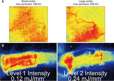 Radial Type Low Intensity Extracorporeal Shockwave Therapy Enhances