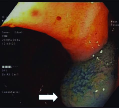 Ileocecal Valve Transition Between Ileum And Tubular Adenoma Download Scientific Diagram