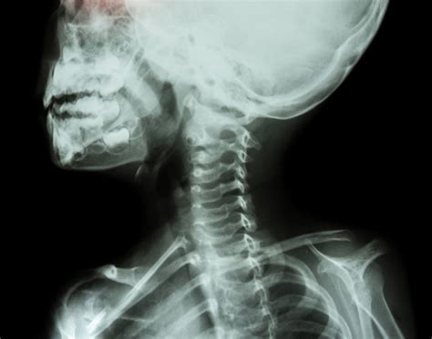 Xray Skeleton Causes Symptoms Treatment Xray Skeleton Bone Tumors