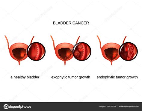 Exophytic Papilloma Of Bladder