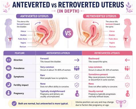 Anteverted Uterus Doctor Explains What It Means And Symptoms
