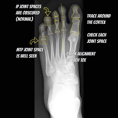 Foot Skeleton Xray X Ray Imaging Test Quickly Helps Find Diagnosis