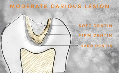 All About Teeth Selective Caries Removal Protocol