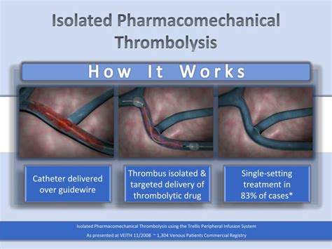 Ppt Endovascular Treatment For Patients With Deep Vein Thrombosis
