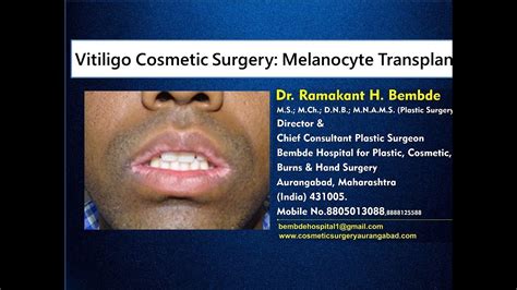 Leucoderma White Patches Or Vitiligo Face And Body Cosmetic Treatment With Melanocyte Transplant