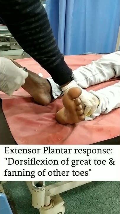 Babinski Sign Extensor Plantar Response Umnl Clinical Medicine