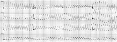 Ventricular Flutter • Litfl • Ecg Library Diagnosis
