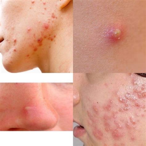 Kem Cephar LoẠi BỎ MỤn MỤn ĐỎ SƯng TẤy 🔥 Giá Tốt Lịch Sử Giá