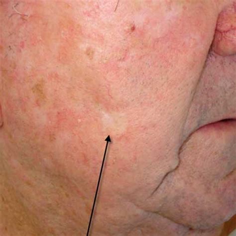Skin Cancer Melanoma Signs And Symptoms Skin Cancer Images And