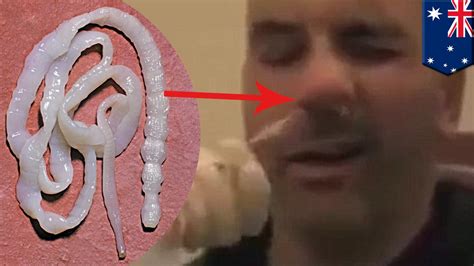 Man Gets 5 Foot Long Tapeworm Extracted From Nose In Horrifying Video