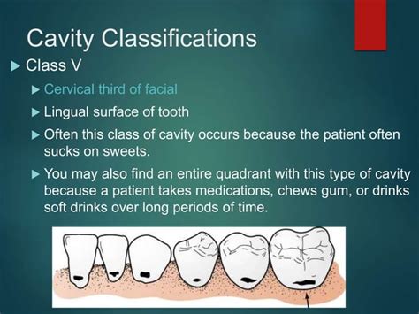 Dental Charting Cavity Classification Basic Charting Terms