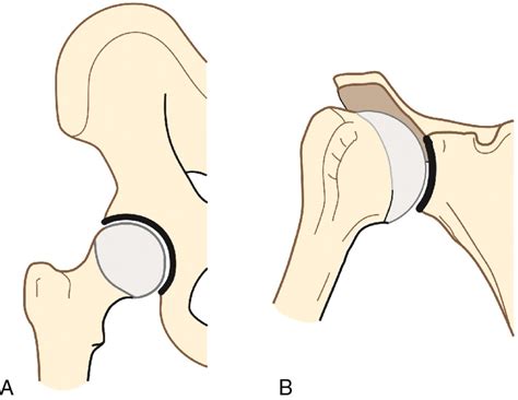 Opinion Editorial—concavity Compression Musculoskeletal Key