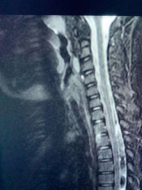 Retropharyngeal Lymph Node Rradiology